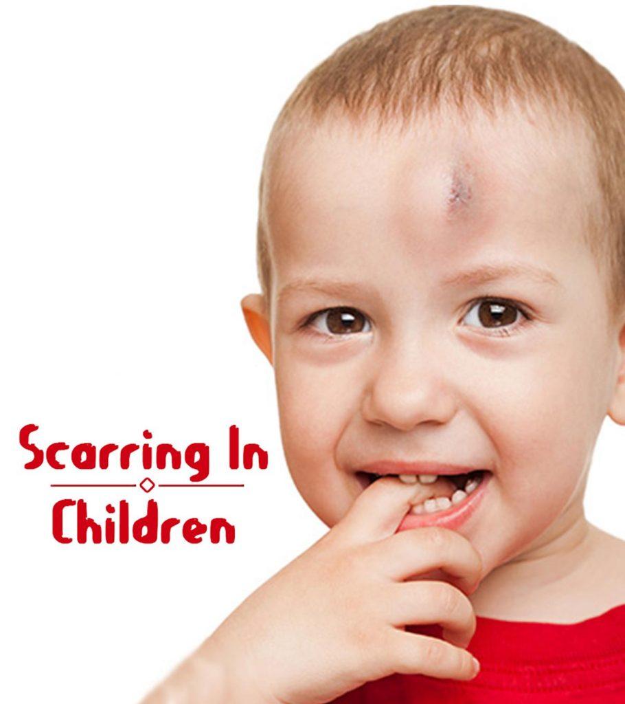 8 Simple Ways To Treat Kids Scars And Prevention Tips | MomJunction