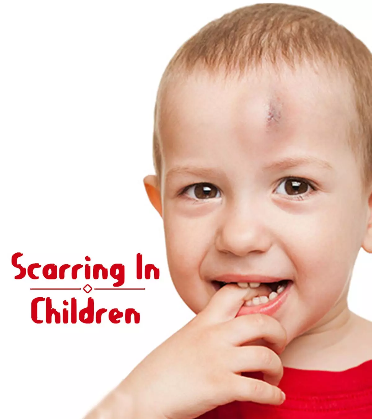 8 Ways To Treat Scars In Children And Tips For Prevention
