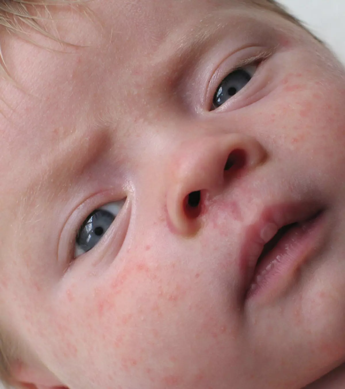 Skin Allergies In Babies: 5 Common Types And Prevention Tips