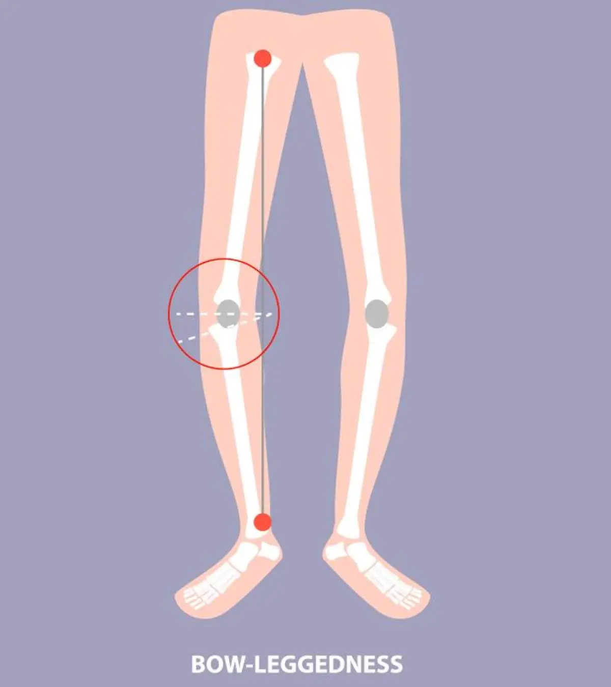 What Are Bowed Legs In Babies? Causes And Treatment