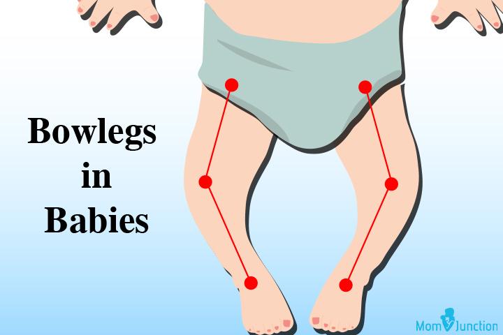 Bow Legged Baby: Causes, Symptoms, Treatment And Prevention