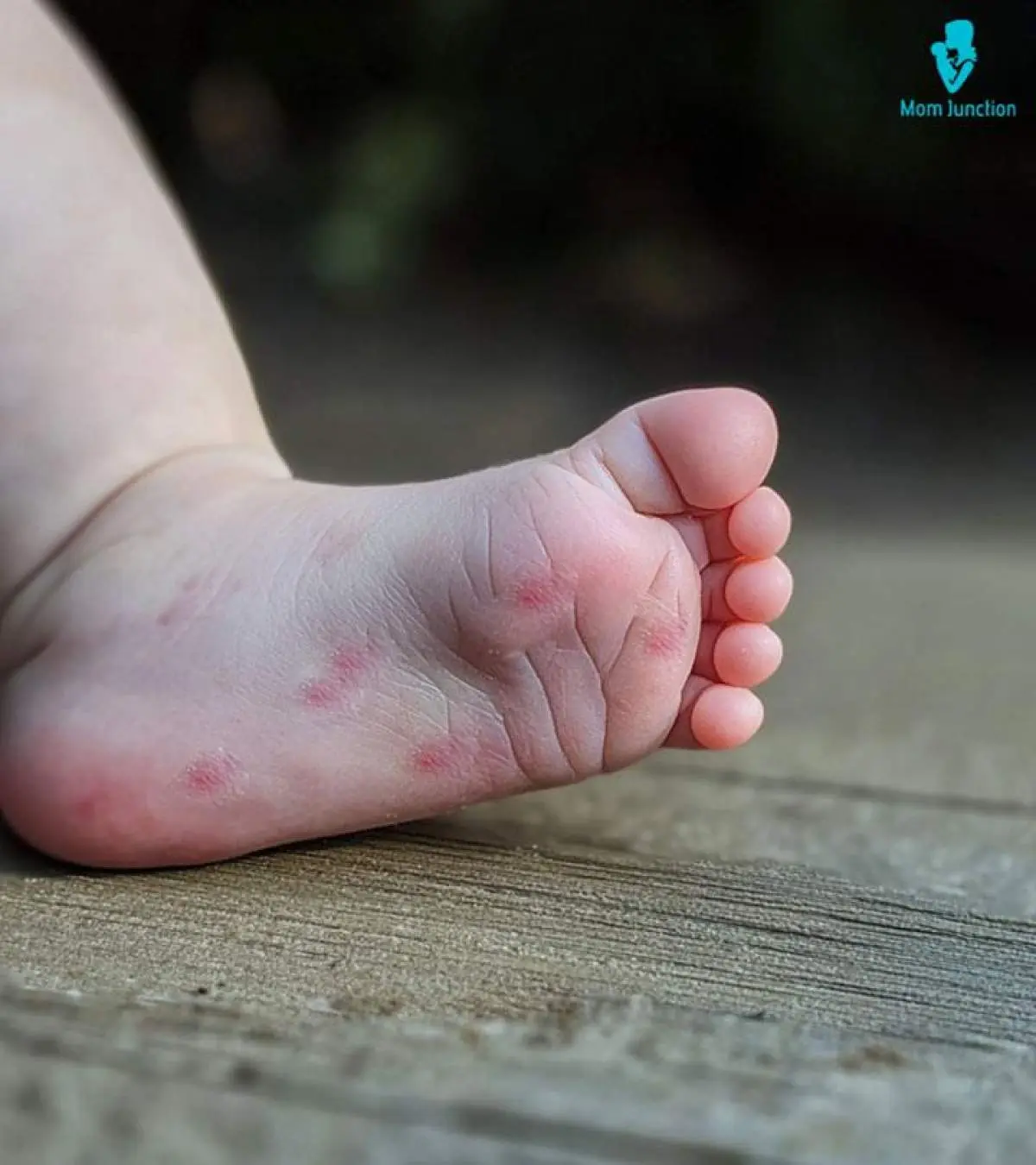 Hand Foot And Mouth Disease Baby What Is Hand, Foot, And Mouth