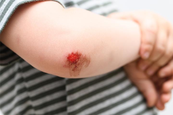 Staph Infections In Kids: Symptoms, Treatment & Home Remedies