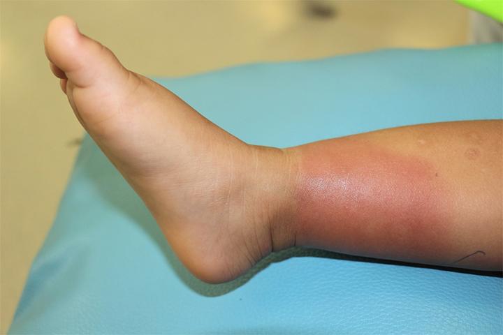 Staph Infection On Leg