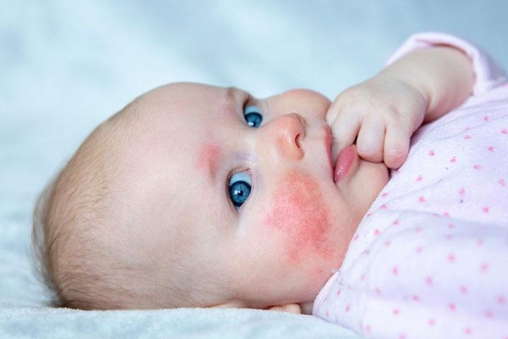 8 Remedies To Treat Swollen Gums In Babies When Teething