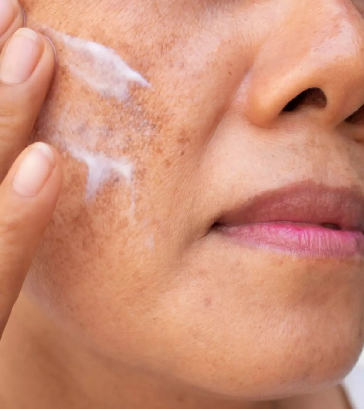 Pregnancy Melasma (Chloasma): What It Is, Causes & Treatment