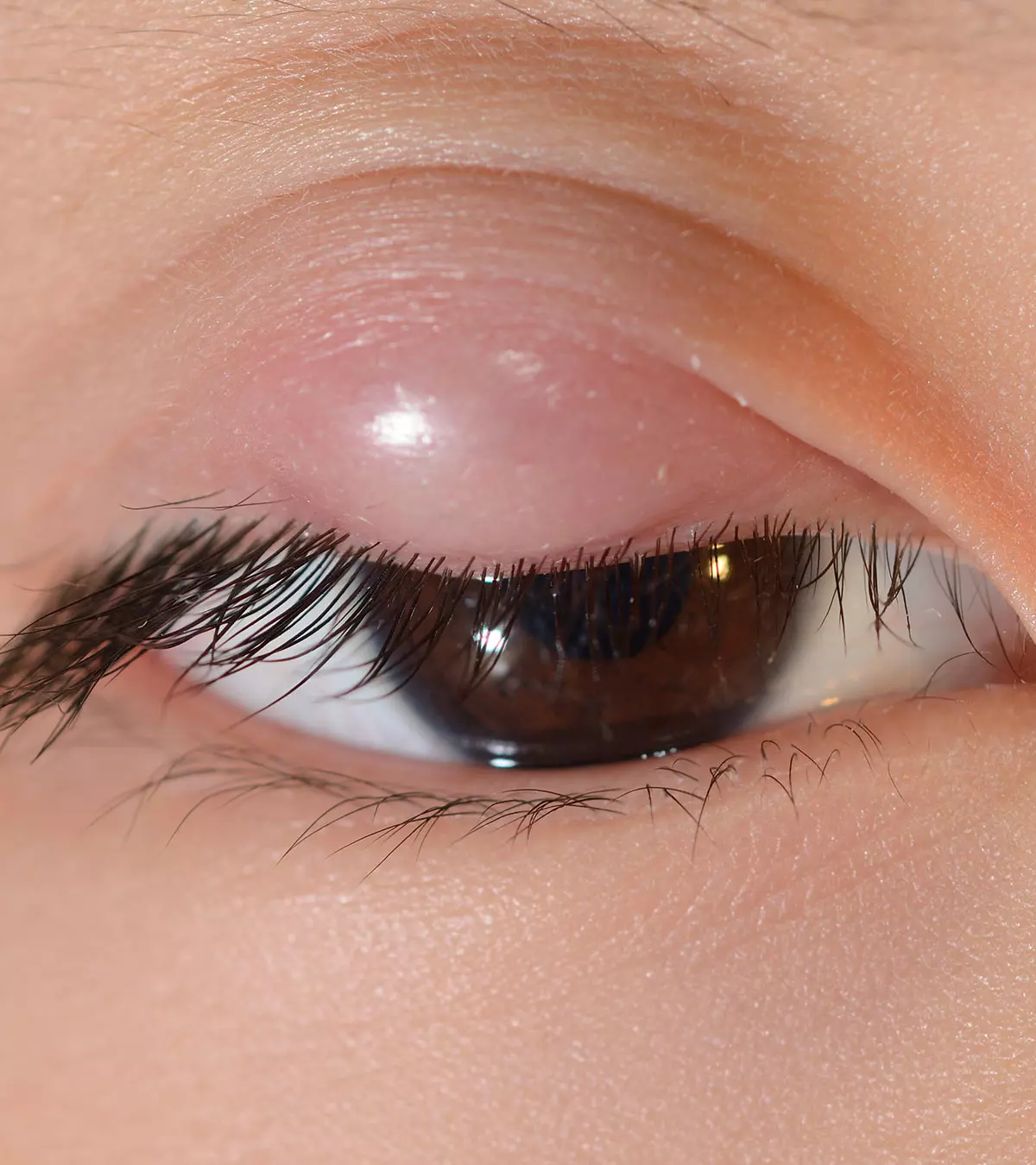 What Causes Sty In Babies: Treatment And Prevention