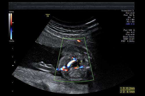 What is the umbilical cord and its effects on pregnancy