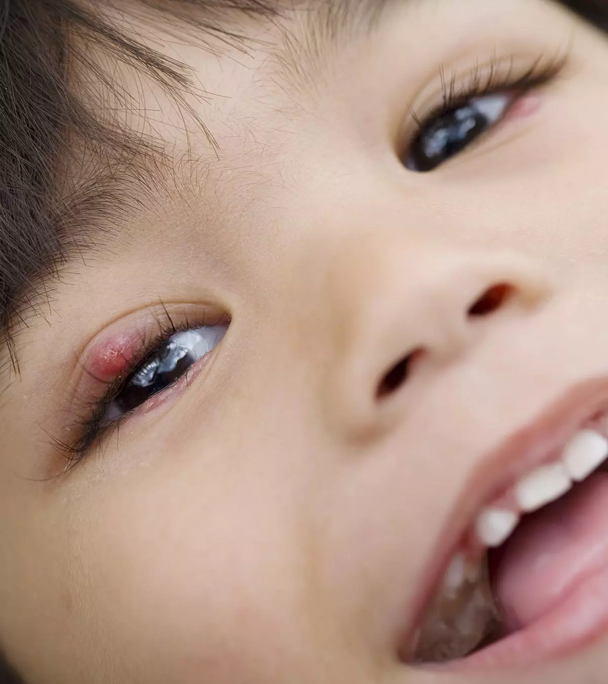 Stye In Children: 6 Effective Home Care Tips For Fast Relief