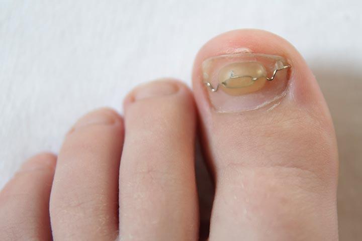 Infected Ingrown Toenail Child