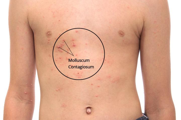 Molluscum Contagiosum In Children - Causes And Treatment