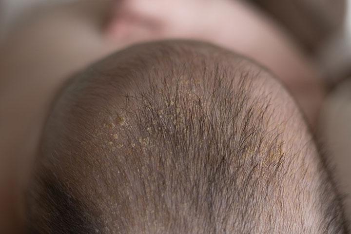 Blepharitis In Babies: Symptoms, Causes, And Treatment