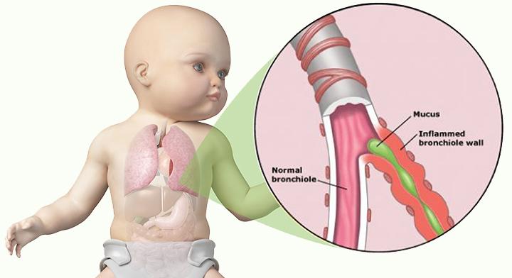 Bronchiolitis In Babies: Causes, symptoms And Treatment