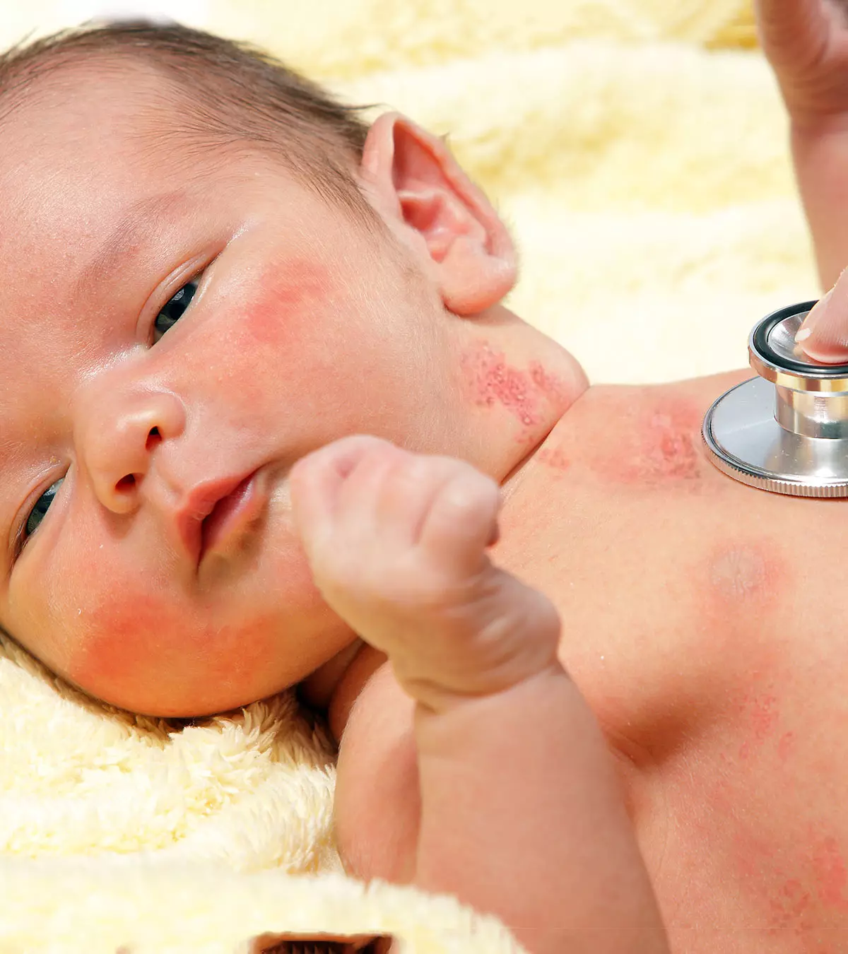 Shingles In Babies: Causes, Symptoms, And Treatment Tips