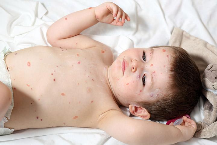 14 Home Remedies For Scabies On Skin Scalp In Children