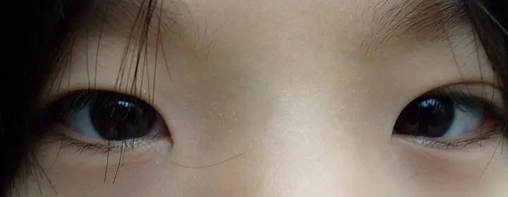 Strabismus In Infants: Symptoms, Causes, Diagnosis And Risks