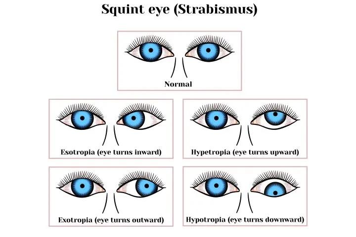 Strabismus In Infants: Symptoms, Causes, Diagnosis And Risks