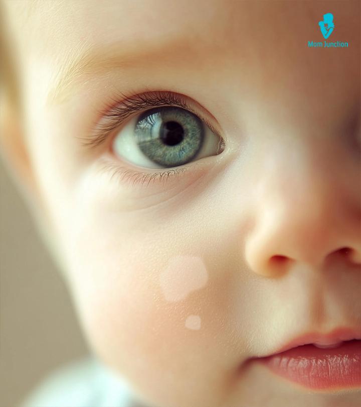 Vitiligo in Children: Causes, Symptoms, Types & Treatment