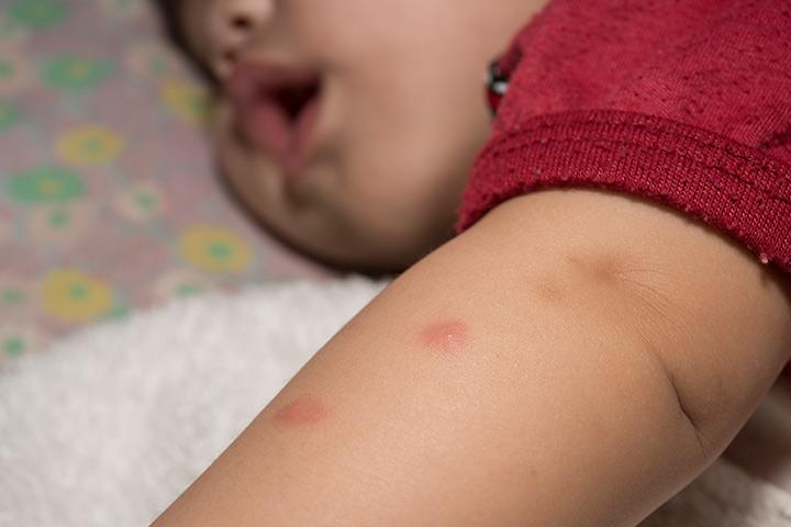 How To Treat And Prevent Mosquito Bites In Babies?