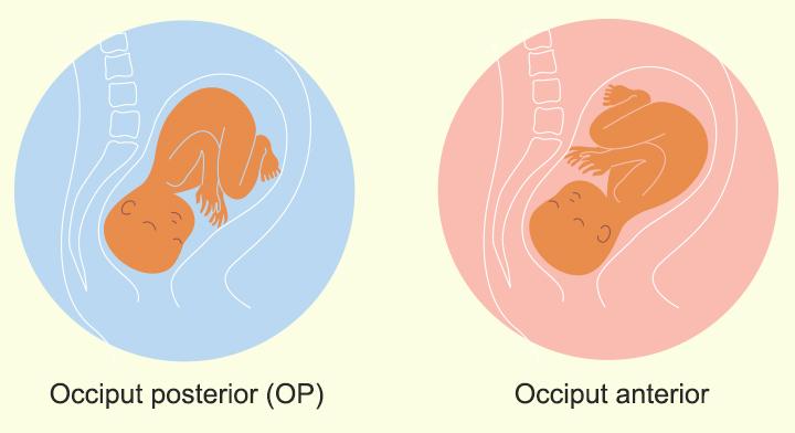 Back Labor: Why Does It Happen And How To Get Relief?