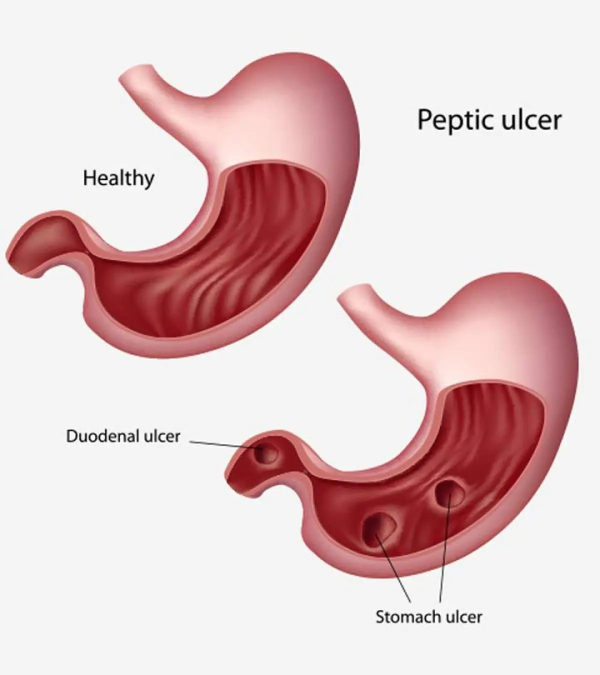 Stomach Ulcer During Pregnancy: Causes, Symptoms & Treatment