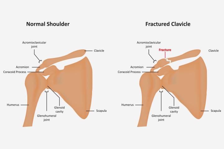 Broken Collarbone In Children: Causes, Symptoms & Treatment