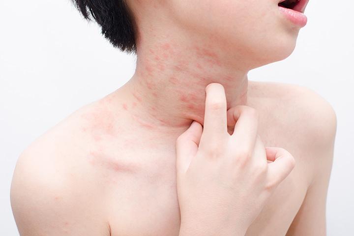 Skin Rashes In Children: Causes, Treatment And Prevention
