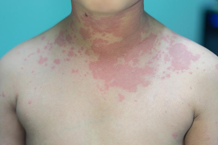 Skin Rashes In Children: Causes, Treatment And Prevention