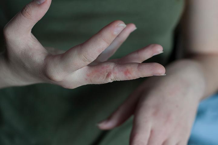 Skin Rashes In Children: Causes And Treatment