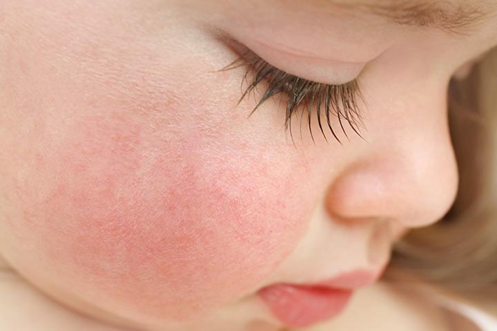 Toddler Rash On Face