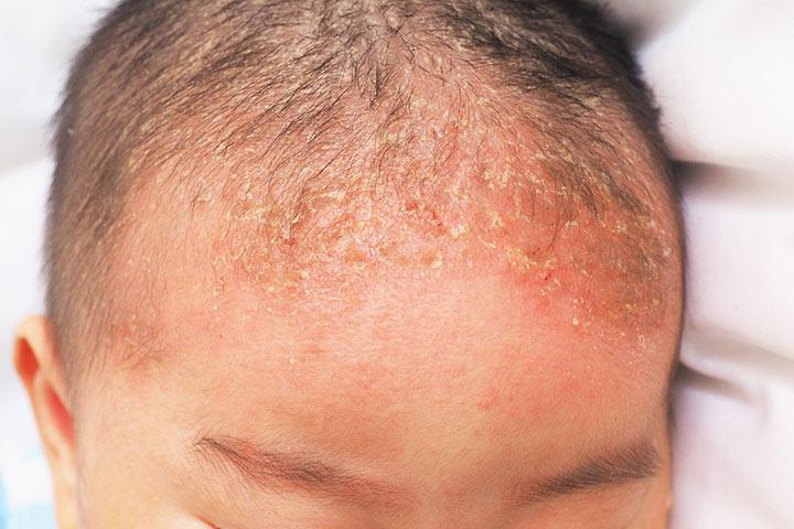 What Cause Rashes In Babies And How To Prevent Them?