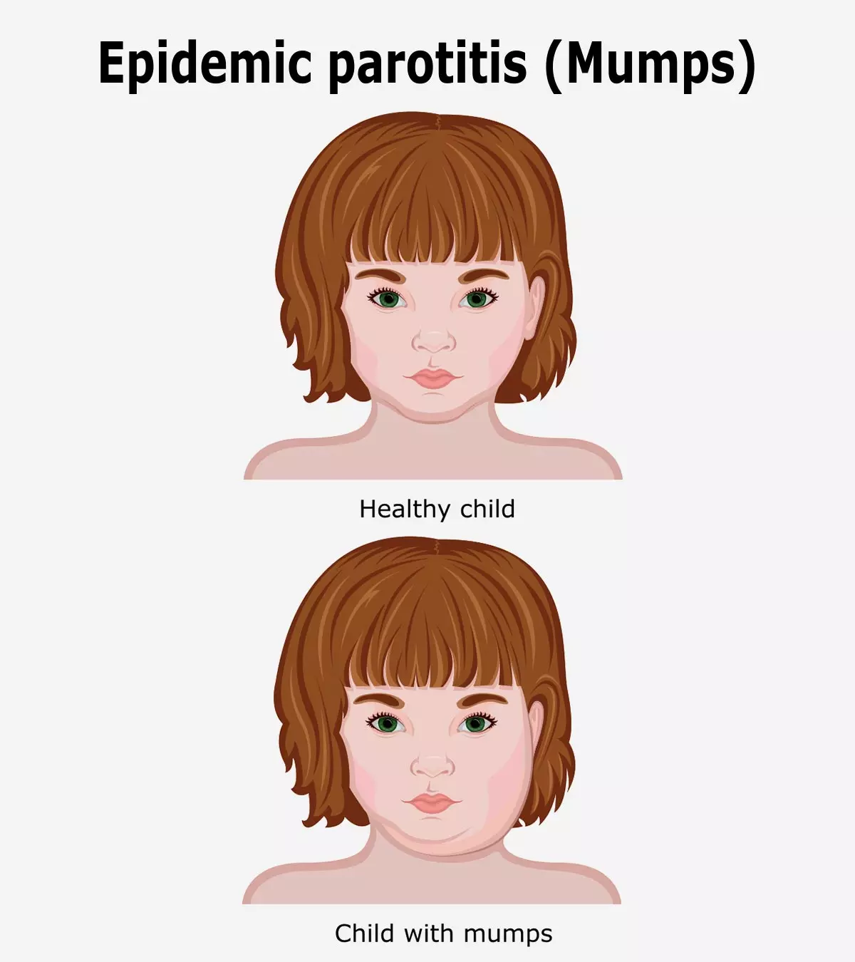Mumps In Children: Symptoms, Diagnosis & Prevention