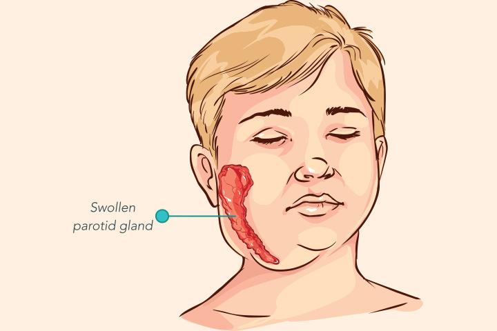 Parotid Gland Swelling Causes