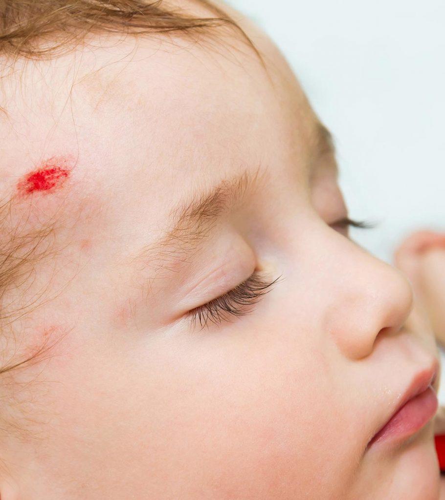 10 Signs Of Concussion In Babies, Causes And Treatment | MomJunction