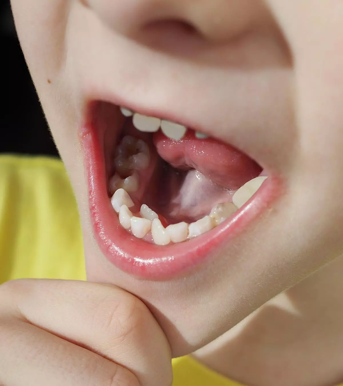 Hyperdontia In Children: Causes, Symptoms, Treatment Guide