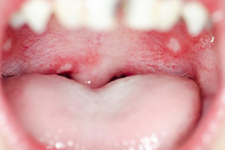 Multiple Canker Sores Under Tongue
