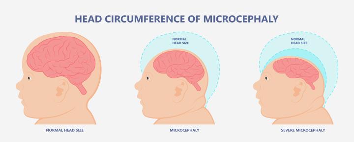 Macrocephaly In Babies: Possible Causes, Diagnosis & Treatment
