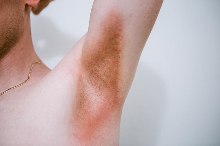 Psoriasis in Children: Types, Causes, Symptoms, And Treatment