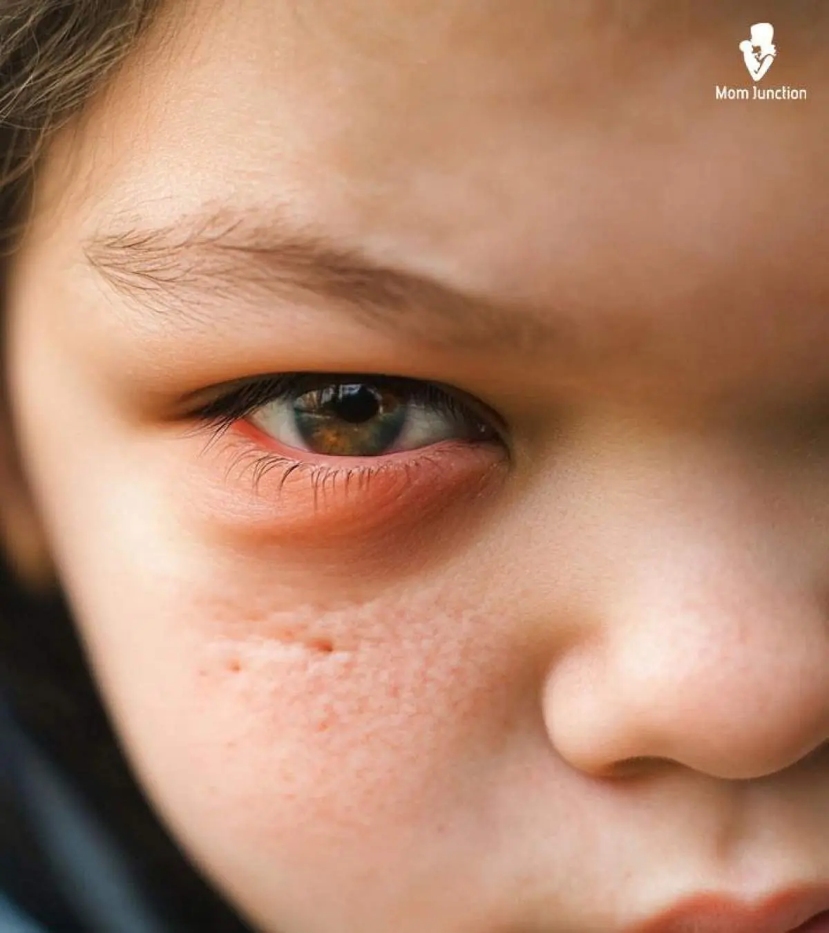 Eye swollen shut store