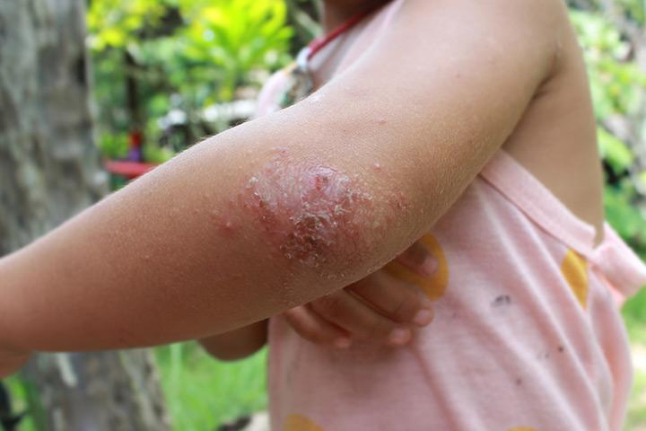 Psoriasis in Children: Types, Causes, Symptoms, And Treatment