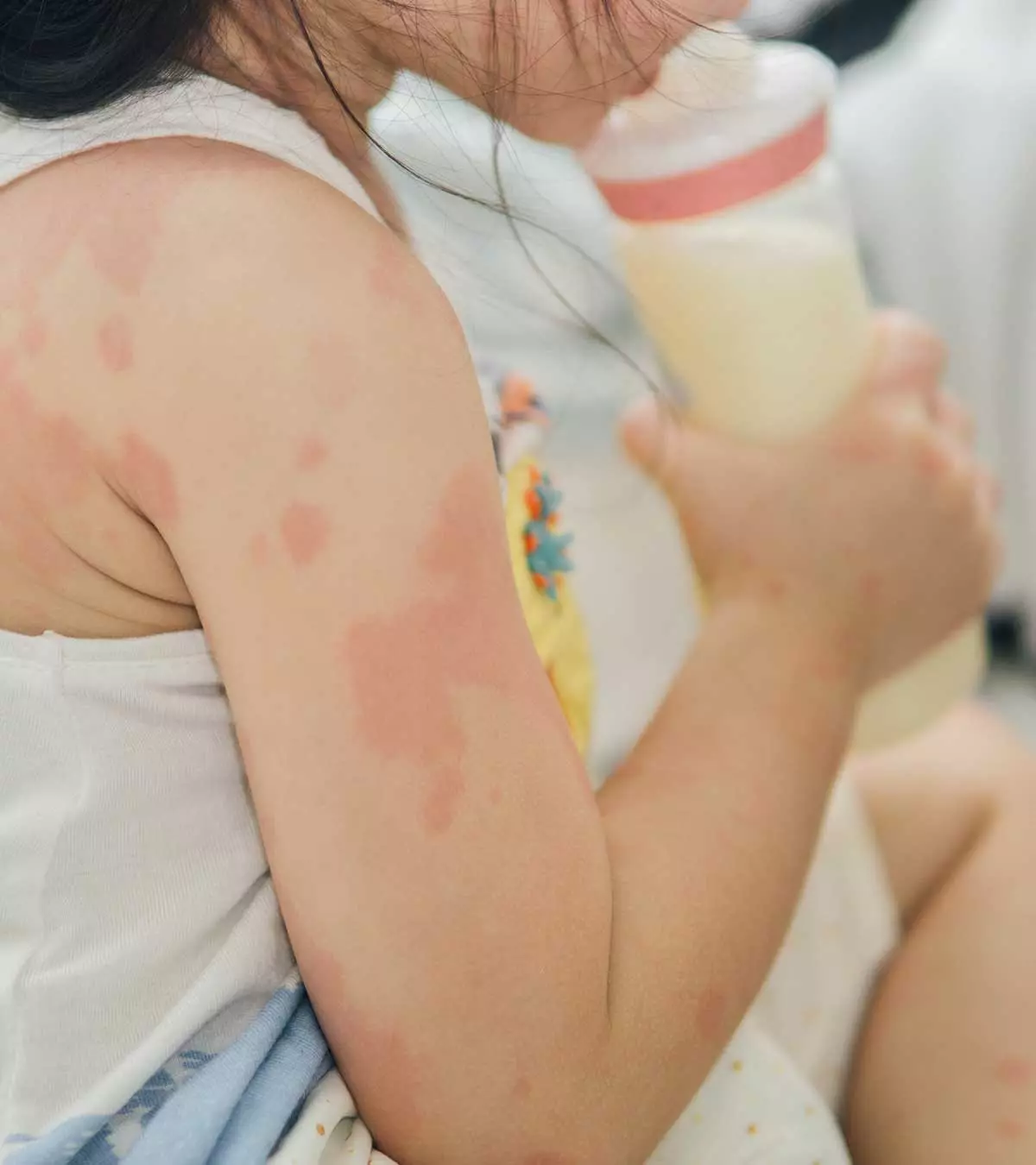 Milk Allergy In Children: Causes, Symptoms & Treatment Guide