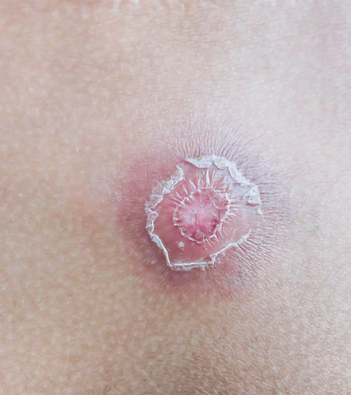 Skin Abscess In Children: An Essential Guide For Parents