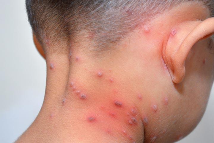 Viral Rashes in Babies: Types, Pictures, Diagnosis, Treatment