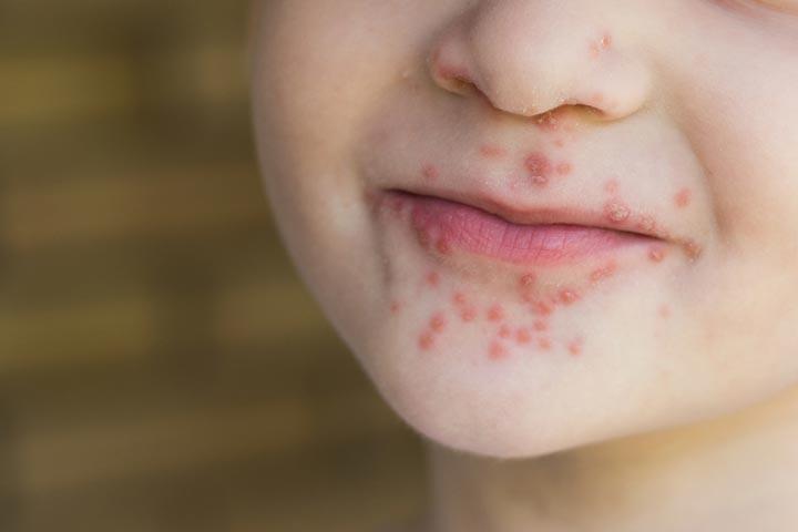 Viral Rash On Face