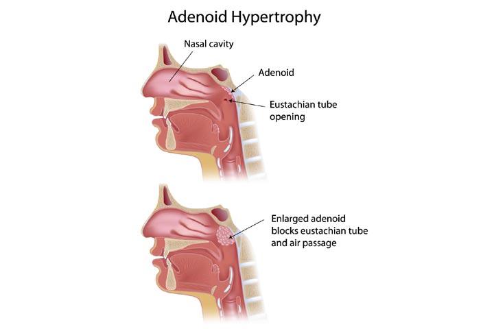 Enlarged Adenoids In Children: Symptoms, Removal & Treatment