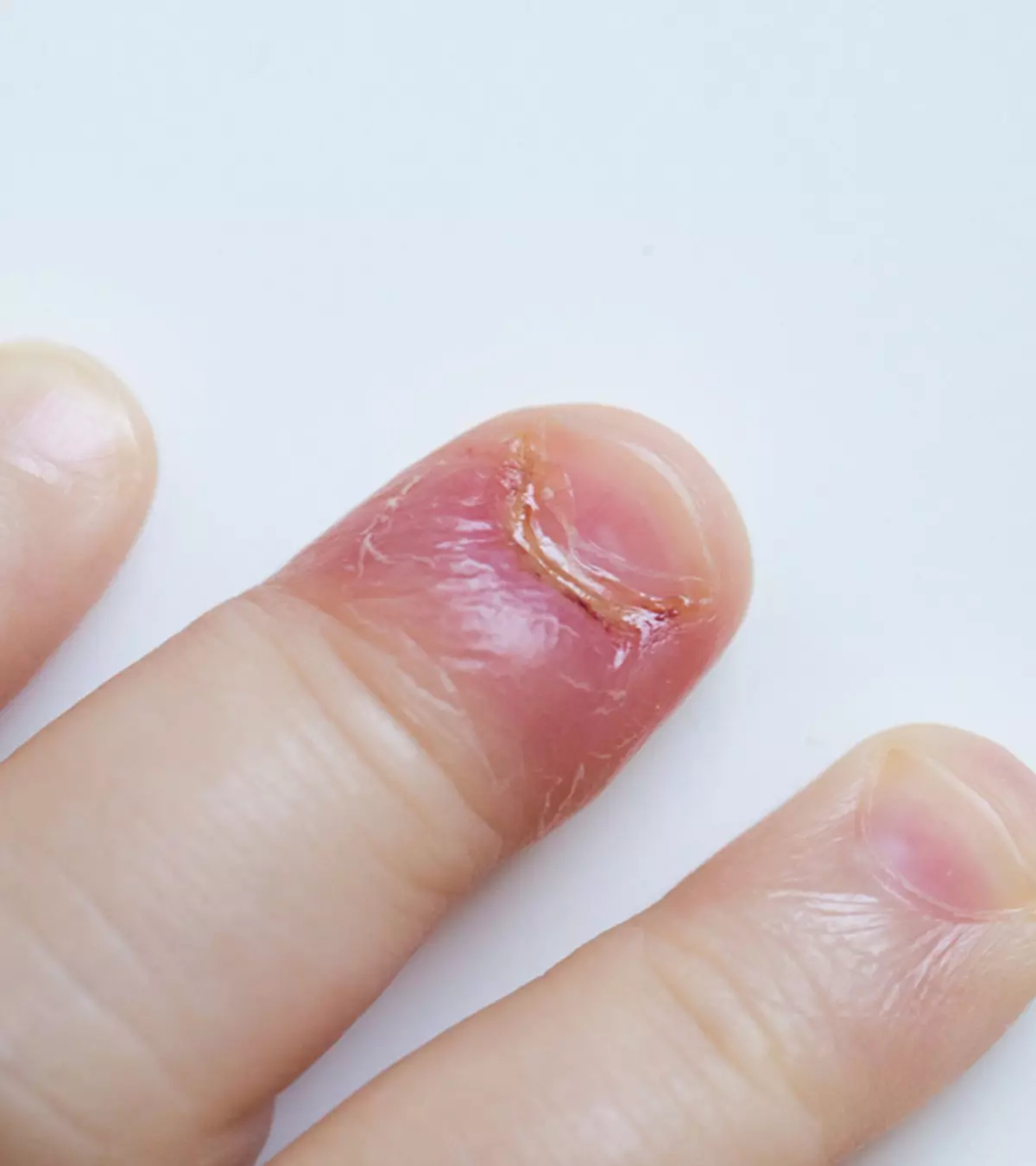 5 Effective Ways To Treat And Prevent Yeast Infection In Children