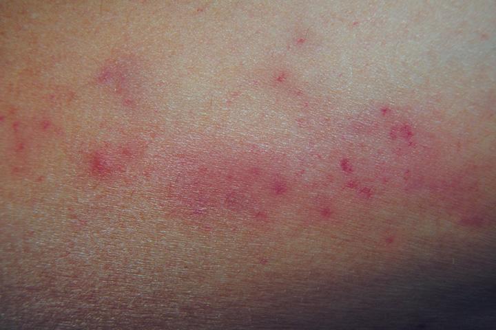 Petechiae Rash