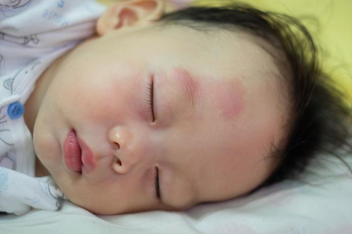 Bruising In Babies: Is It Normal, Causes And Treatment