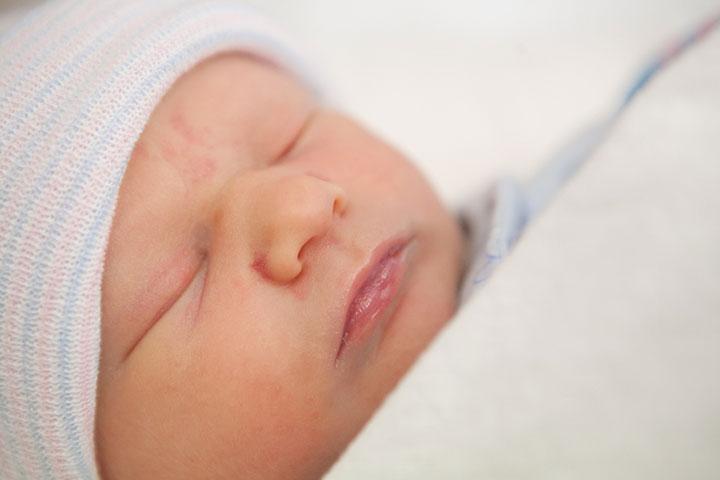 Port Wine Stains In Babies: Causes And How To Treat Them