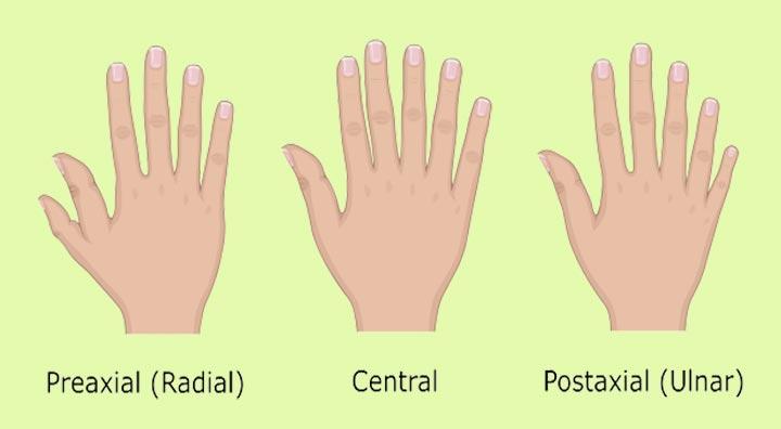 Polydactyly (Extra Fingers On Babies): Causes And Treatment